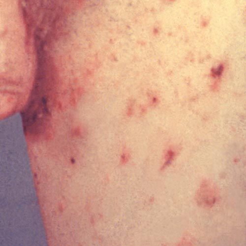 Photo Gallery Of Scabies Causes And Treatment