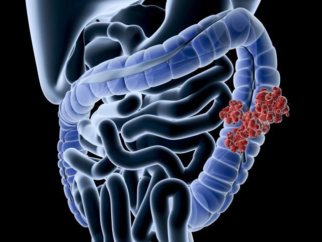 Types And Location Of Colon Cancer