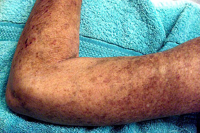 Types Of Scleroderma Systemic Sclerosis