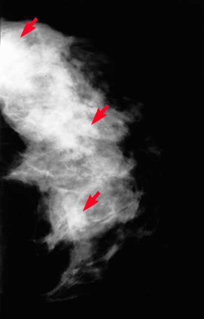 All About Breast Fibroadenomas